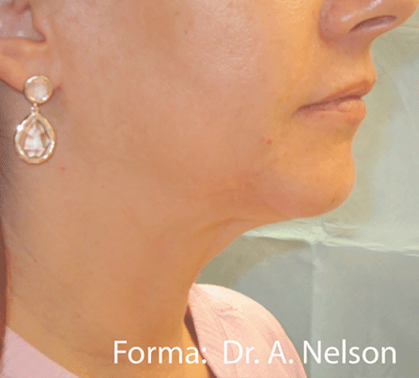 Fotos antes y después - Inmode Mexico